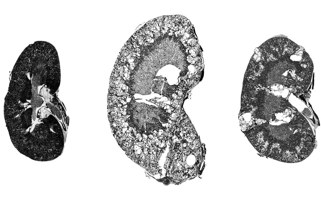 A new drug candidate can shrink kidney cysts – MIT Department of Chemistry